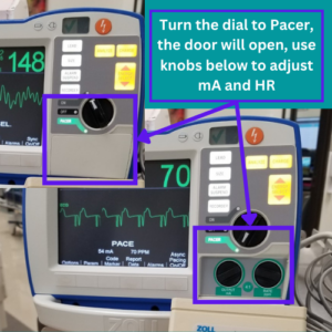 Transcutaneous Pacing (TCP) - CPR Done Right | CPR, ACLS, BLS, PALS ...