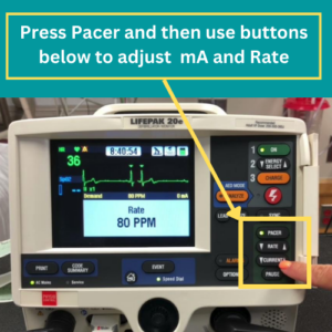 Transcutaneous Pacing (TCP) - CPR Done Right | CPR, ACLS, BLS, PALS ...