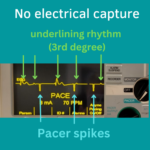 Transcutaneous Pacing (TCP) - CPR Done Right | CPR, ACLS, BLS, PALS ...