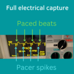 Transcutaneous Pacing (TCP) - CPR Done Right | CPR, ACLS, BLS, PALS ...