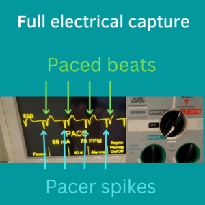 Transcutaneous Pacing (TCP) - CPR Done Right | CPR, ACLS, BLS, PALS, NRP, Courses